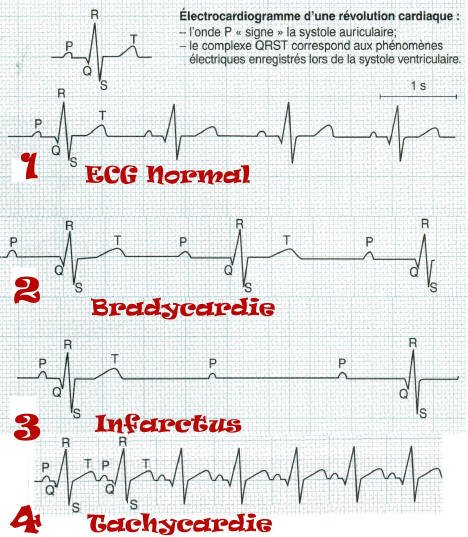 Electrocardiogramme Ecg Definition Fonctionnement Et Risques De Images Electrocardiogramme Ecg Definition Fonctionnement Et Risques De Images