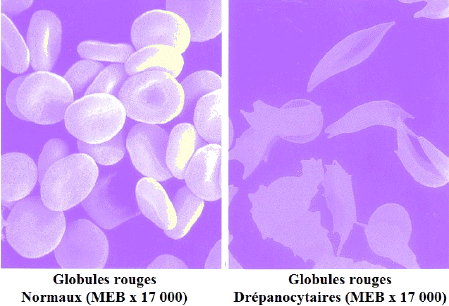 Une pathologie grave : la drépanocytose